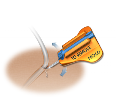 Placement & Removal Procedures - SecurAcath